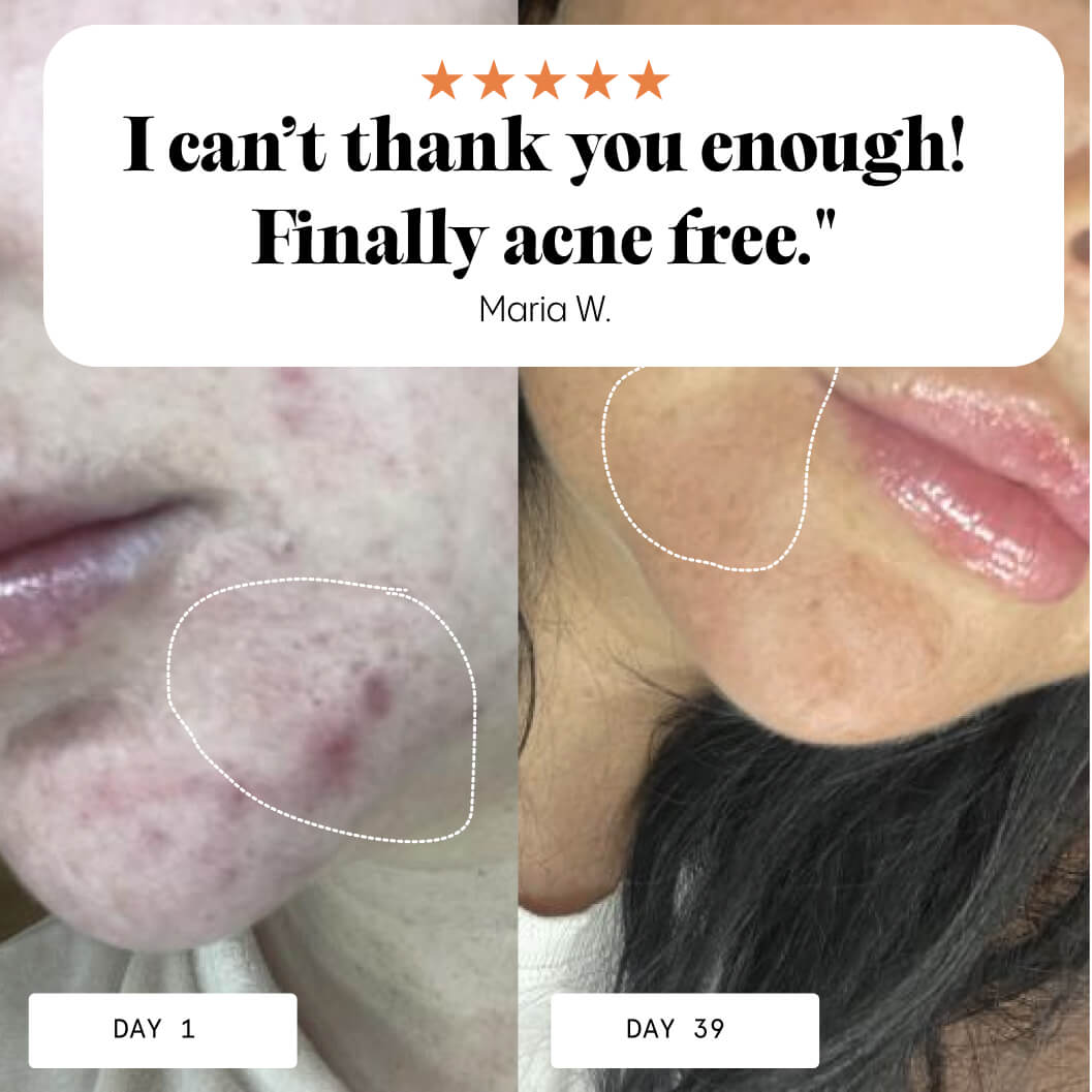 The Complete Acne System for Women | Frøya Organics