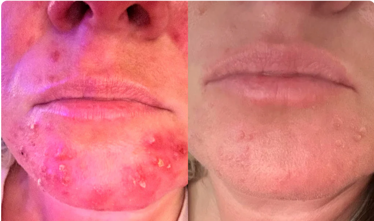 The Complete Acne System for Women | Frøya Organics